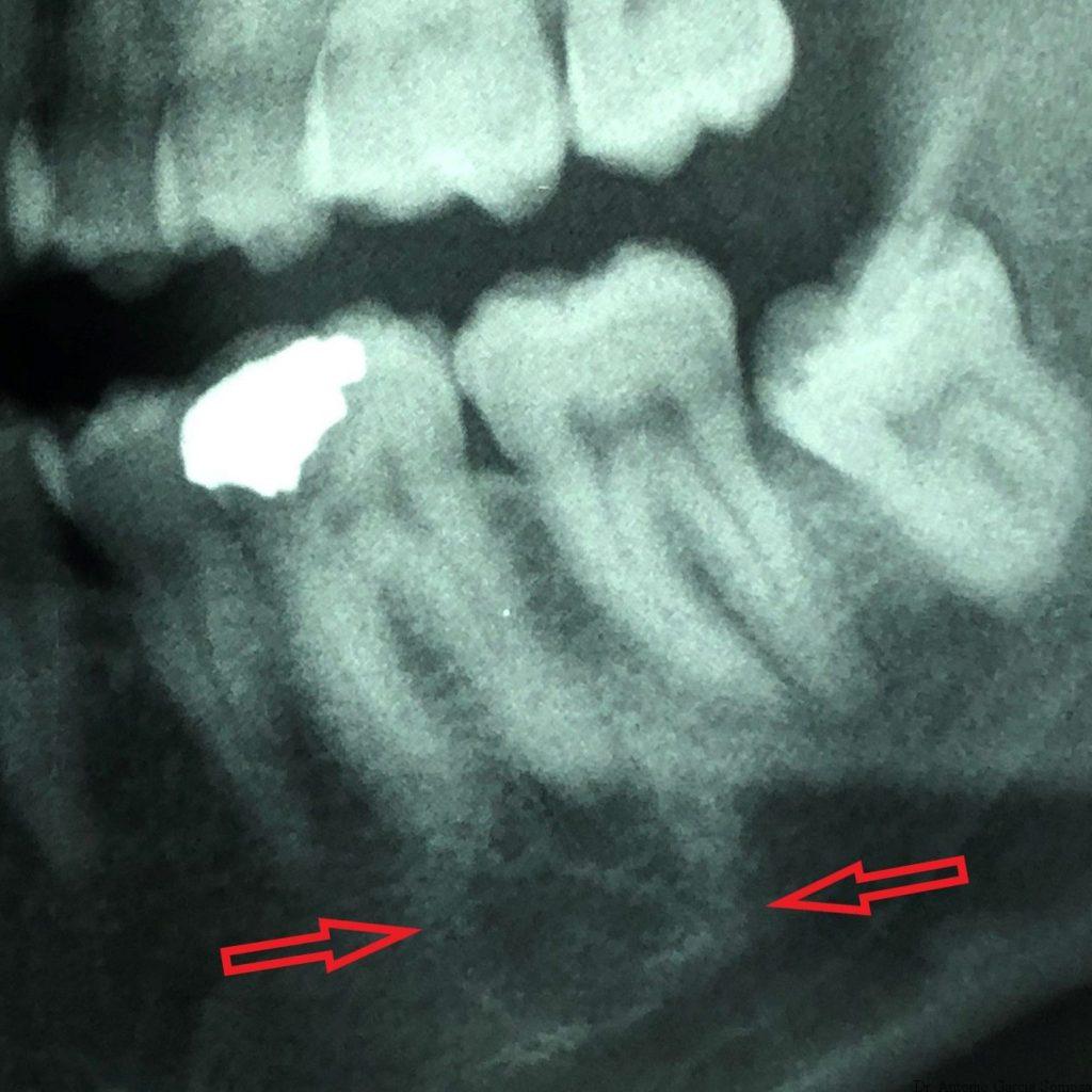 Proceso infeccioso periapical - Clínica dental García Somoza