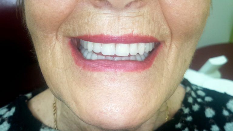 Paciente edéntulo total - Clínica dental García Somoza