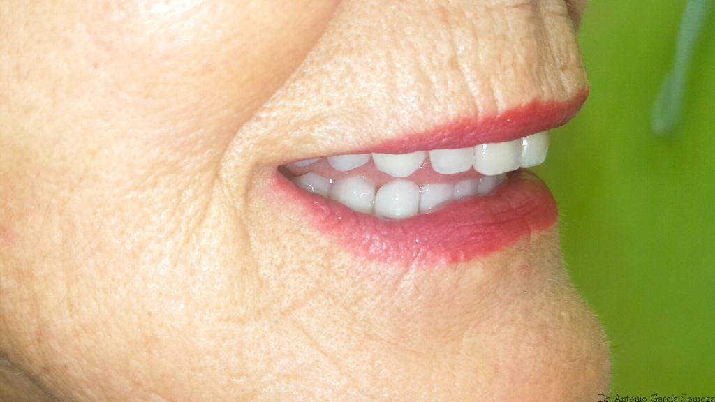 Paciente edéntulo total - Clínica dental García Somoza