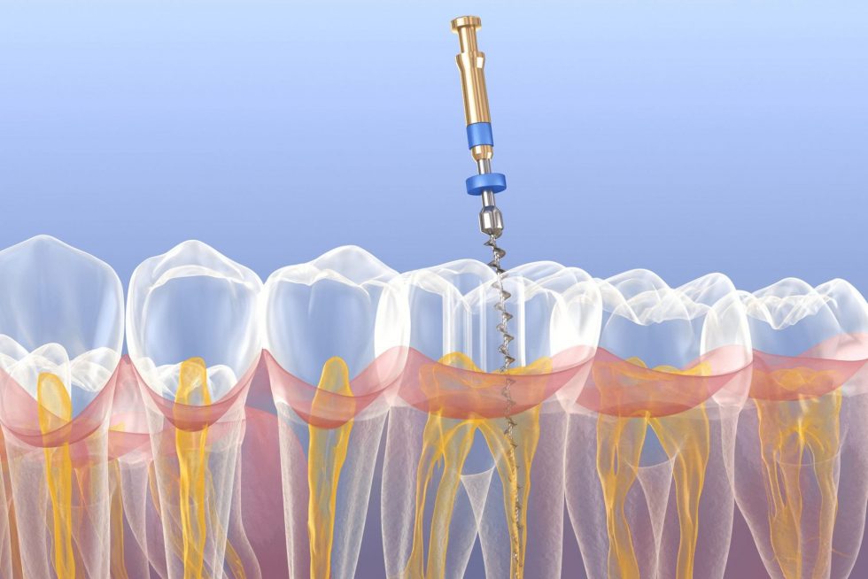 ¿Qué es un tratamiento de endodoncia? - Clínica dental García Somoza