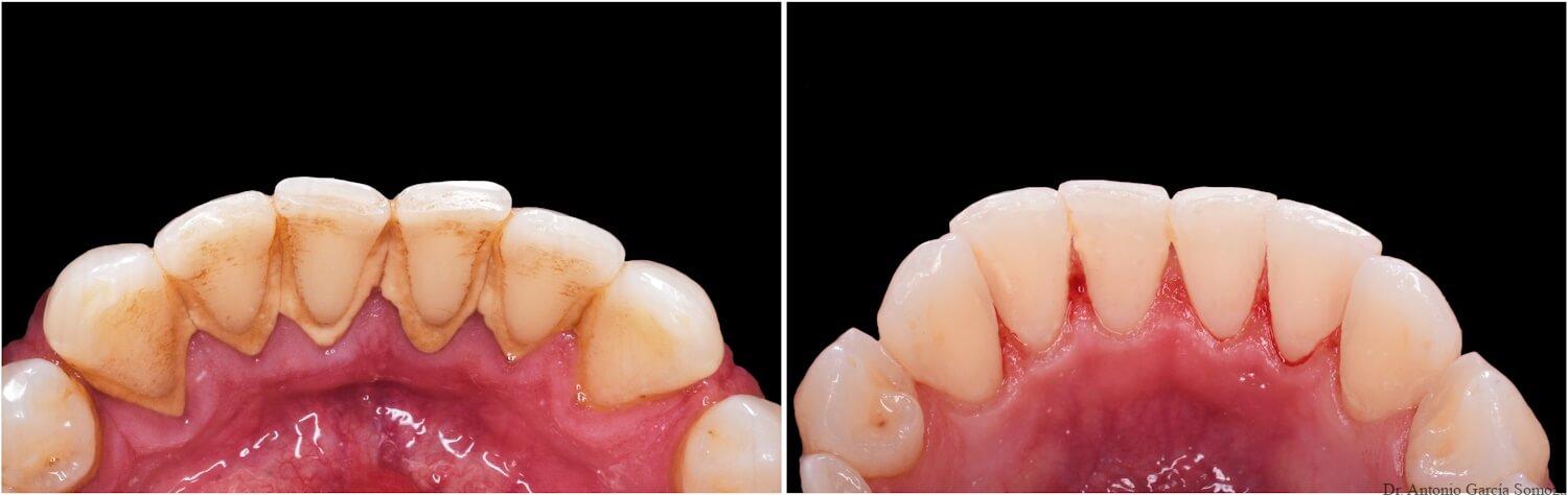 Todo lo que necesitas saber sobre la placa dental: su impacto en la ...